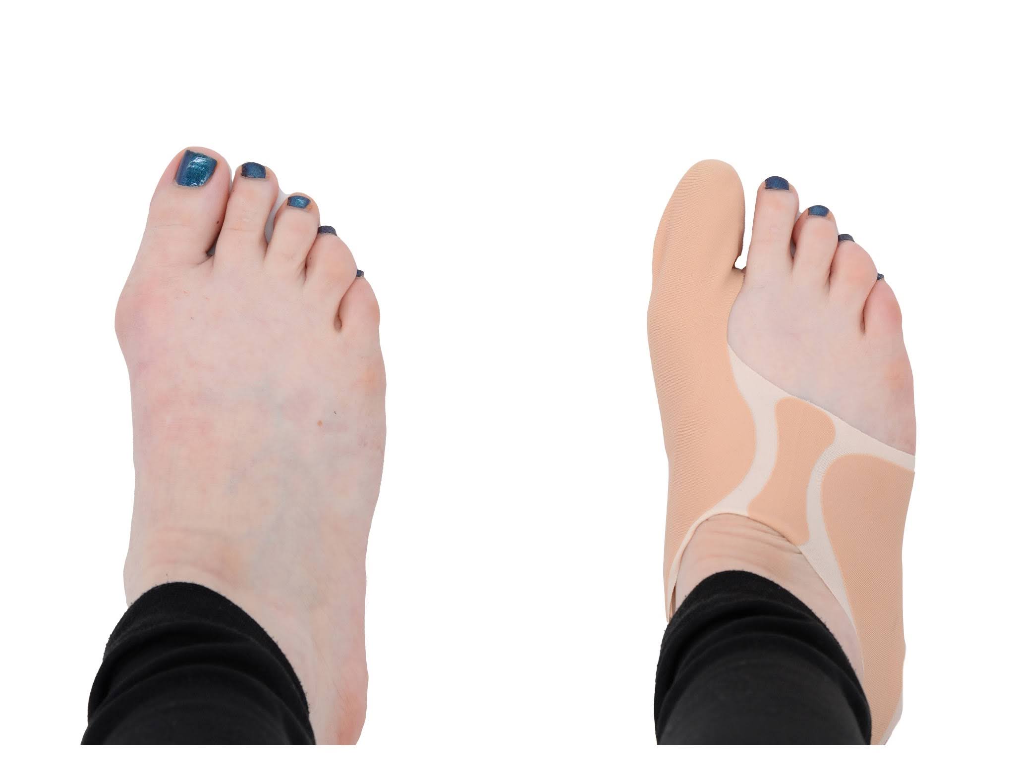 Hallux Valgus: Causes, Symptoms, and Treatment Options